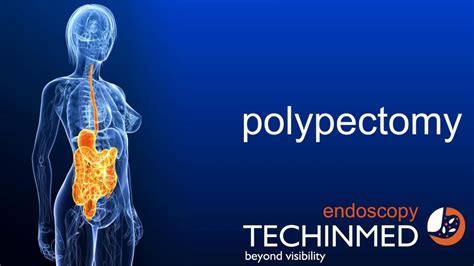 Endoloop Polypectomy At Jose Caceres Blog