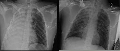 Donor Lung Procurement By Surgical Fellow With An Expectation Of High