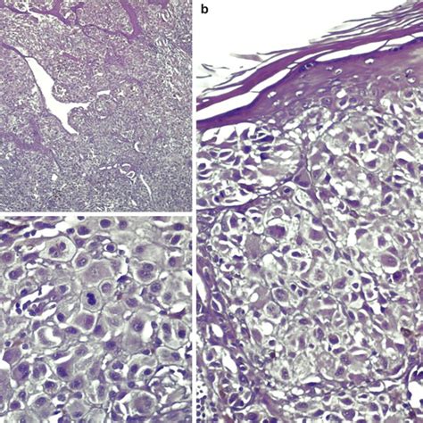 A D Bcc Nodular Type The Figures Show A Bcc Nodular Type With Download Scientific Diagram