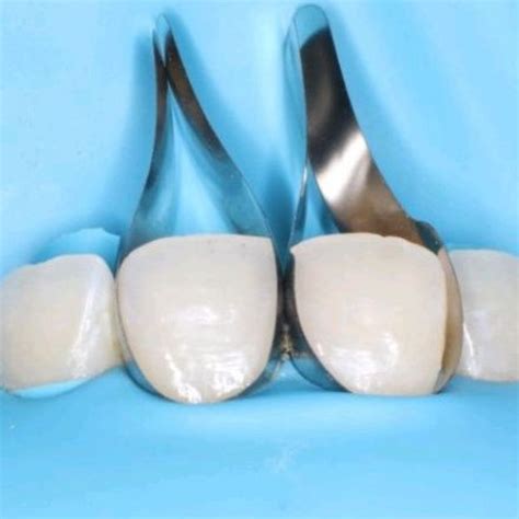 Jual Original Tor Vm Matrix Anterior Twin Matrix Veneer Unica