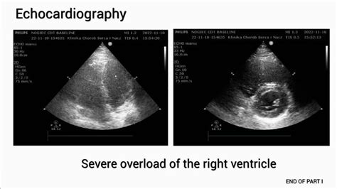 Advancing Percutaneous Treatment Of Pulmonary Embolism With Computer Assisted Vacuum Thrombectomy