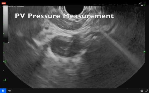 Novel Technique Allowing Direct Measurement Of Portal Pressure Introduced In Eus Guided