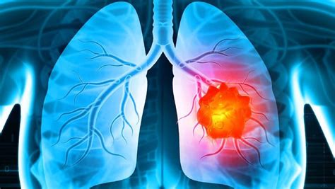 The Importance Of A Second Opinion For Lung Cancer Care
