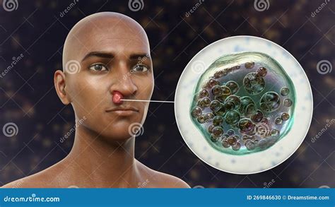 Nasal Rhinosporidiosis In A Patient 3d Illustration A Disease Caused By Rhinosporidium Seeberi