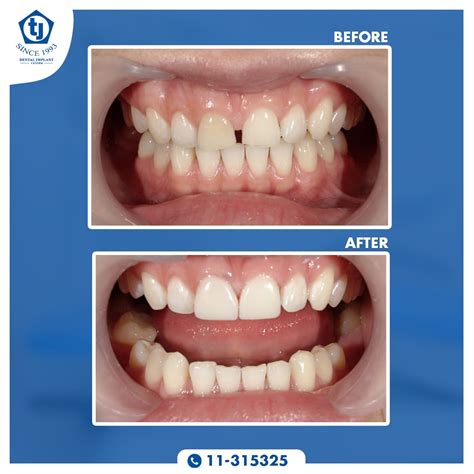 Туждент Таны үүдэн шүдэнд асуудал байна уу Үүдэн шүд асуудалтай байх нь инээмсэглэхэд