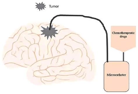 Schematic Diagram Of Convection Enhanced Delivery Download Scientific Diagram