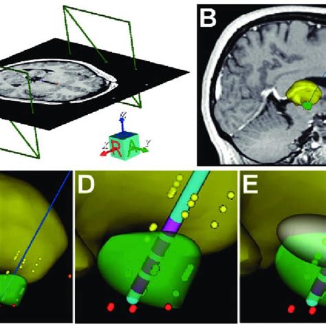 Patient Specific Model Of Dbs A Stereotactic Coordinate System Was Download Scientific