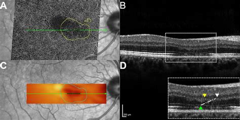 Outer Nuclear Layer ONL Thickness In Acute Macular Neuroretinopathy Download Scientific