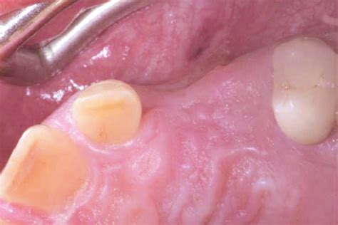 Lateral Block Augmentation In The Posterior Maxilla With Cancellous Maxgraft® Block Botiss