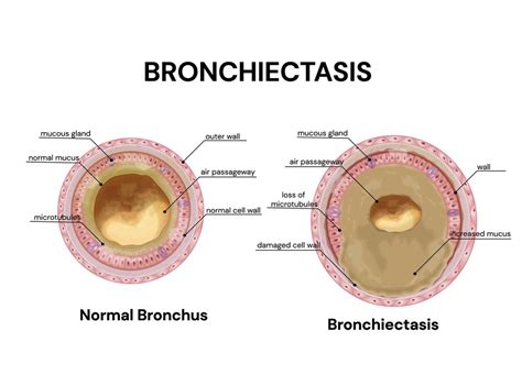 Patient Information On Bronchiectasis