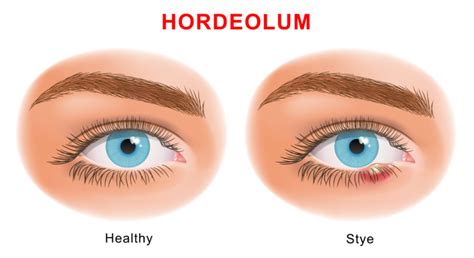 Blepharitis And Stye What Are The Differences