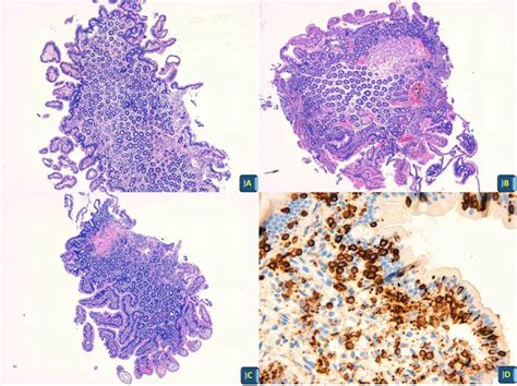 A B C Biopsy Non Oriented Evaluation Of Villous Height And The