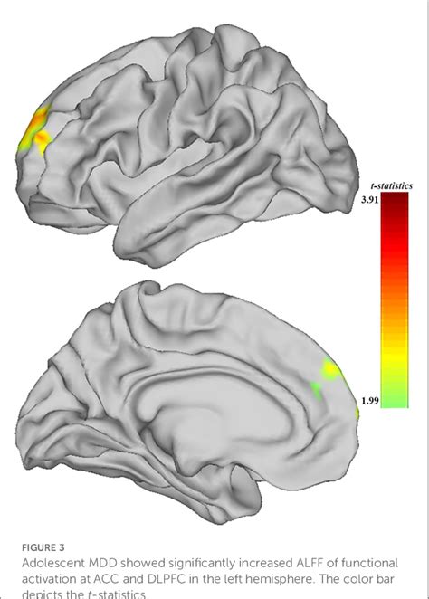 Figure 3 From Severity Related Neuroanatomical And Spontaneous Functional Activity Alteration In