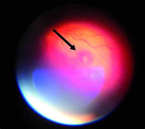 Roth Spots A Red Hemorrhagic Lesion Of The Retina With A Characteristic
