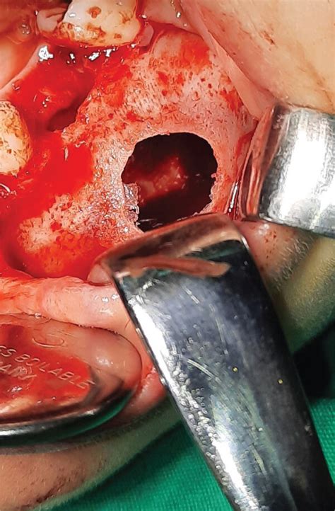 A Bony Defect In The Body Of The Mandible After Cyst Enucleation Download Scientific