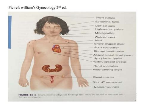 Disorders Of Sex Development Dsd Defination Classification Cah Ais Turners Syndrome