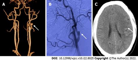 Left Internal Carotid Artery Pseudoaneurysm With Acute Ischemic Stroke