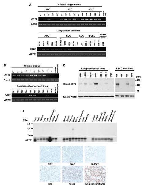 Figure 1 From Involvement Of Epithelial Cell Transforming Sequence 2 Oncoantigen In Lung And