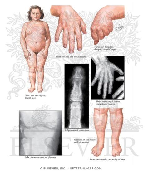 Pseudohypoparathyroidism Face