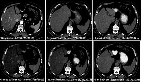 The Association Of Sex Steroid Hormone Concentrations With Non Alcoholic Fatty Liver Disease And