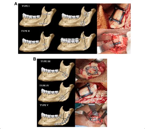 Open Reduction And Internal Fixation Orif Performed A Two Point Download Scientific Diagram