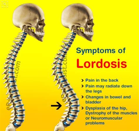 Pin On Lordosis