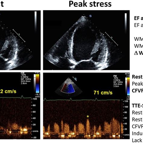 The Normal Pattern Of Normal Resting And Peak Flow Velocity With Download Scientific Diagram