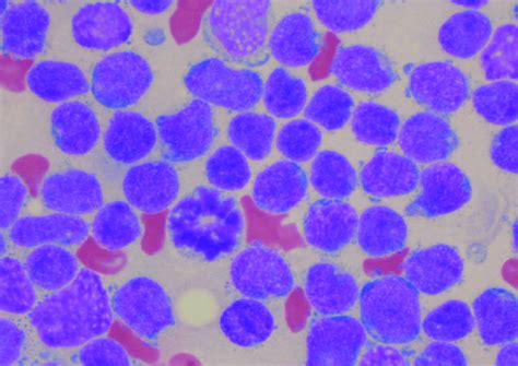 The Bone Marrow Aspirates Showed An Increased Number Of Small Sized Download Scientific Diagram