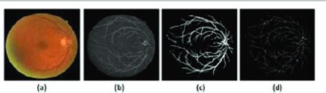 Breakdown Of A Retina Scan A Original Retina Image B Enhanced Download Scientific Diagram