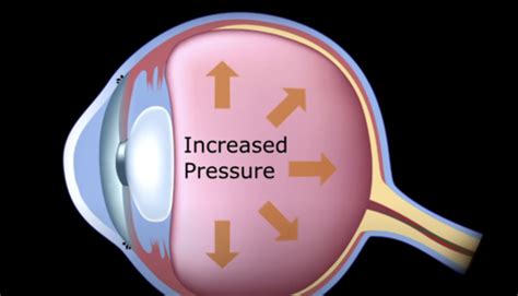 Glaucoma Flashcards Quizlet
