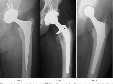 Types Of Femoral Stem Design At Delbert Sanders Blog