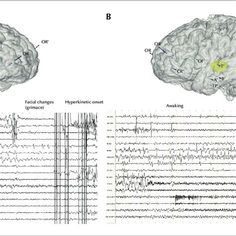 PDF Hyperkinetic Motor Seizures A Common Semiology Generated By Two Different Cortical