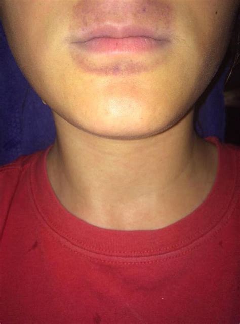 Kylie Jenner Lips Gone Wrong Mirror Online
