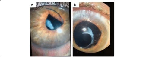 Photos Taken Of Right Eye Showing Dislocated Intraocular Lens A Before