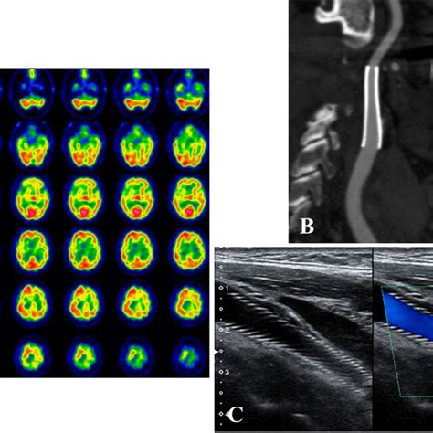 Single Photon Emission Computed Tomography Spect Three Dimensional