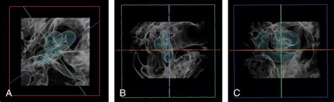 Cochlear Coiling Pattern And Orientation Differences In Coch Otology And Neurotology
