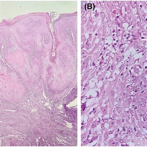 Polypoid And Acanthotic Epidermis With Band‐like Infiltration Of