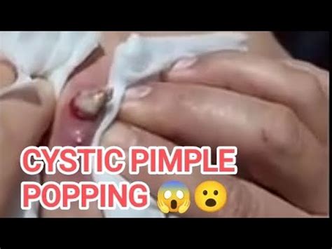 SATISFYING CYSTIC PIMPLE POPPING BE CAREFULL HYGIENE IS IMPORTANT YouTube
