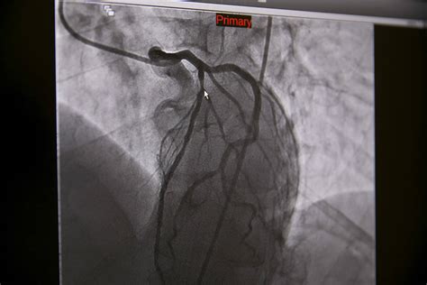 Heart Attack Survivor Tells All Gives Advice Article The 55 Off
