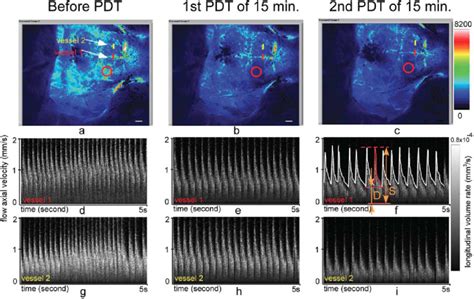 Laser Speckle Imaging And Phase Resolved Doppler Oct Measurements