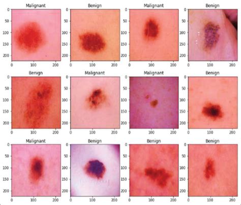 Generative Adversarial Network Image Synthesis Method For Skin Lesion