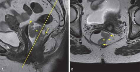 Magnetic Resonance Imaging Staging Of Rectal Cancer Clinical Tree