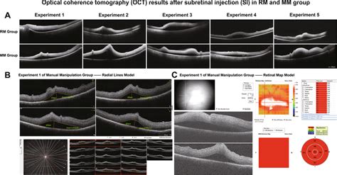 Optical Coherence Tomography Test And Results Of Retina After