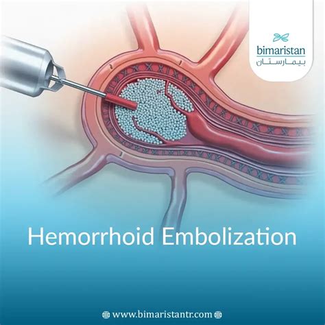 Hemorrhoid Embolization Treatment In Turkey Hemorrhoid Embolization Treatment In Turkey
