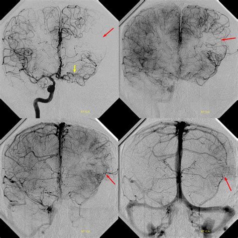Intracranial Collateral Pathways