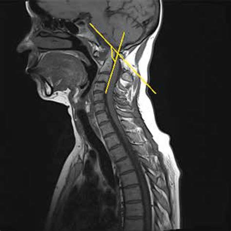 Cervical Spine Mri Anatomy Adult Mri Series Mri Of Cervical Spine