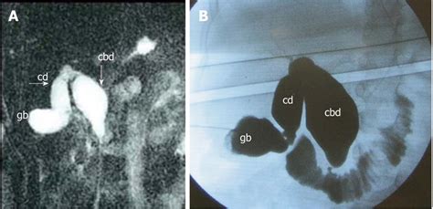 Cystic Malformation Of Cystic Duct 10 Cases And Review Of Literature