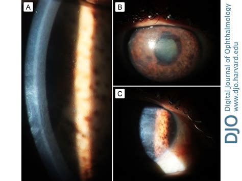 Cogan Reese Syndrome Image Analysis With Specular Microscopy Optical Coherence Tomography And