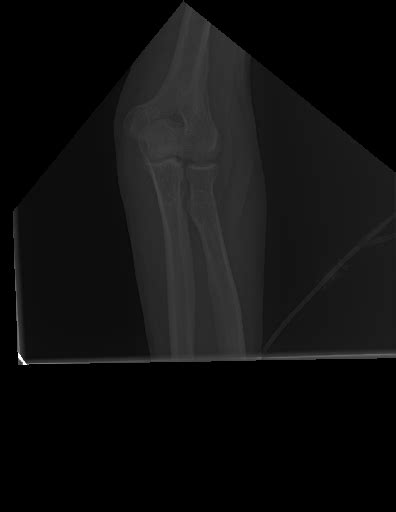 mura fracture detector computer vision dataset by adjibola