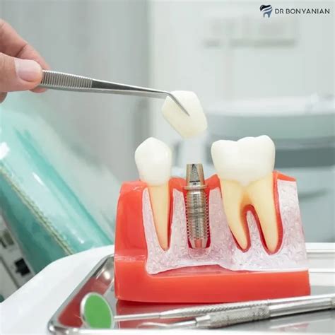 بهترین برند ایمپلنت کره ای کدام است؟ معرفی 10 برند برتر